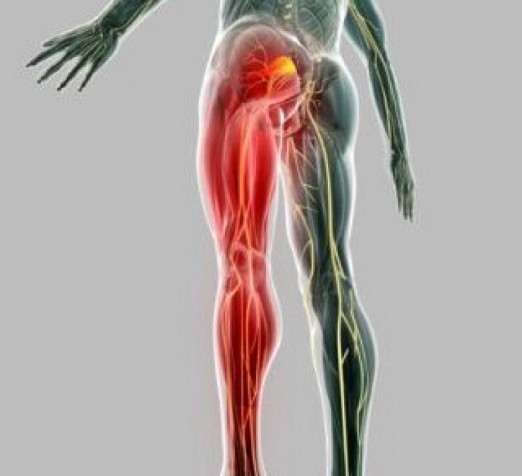 ciatica-causa-diagnostico-e-tratamento - Corpo Mente Saúde